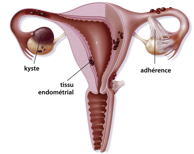 L’endométriose : une solution
